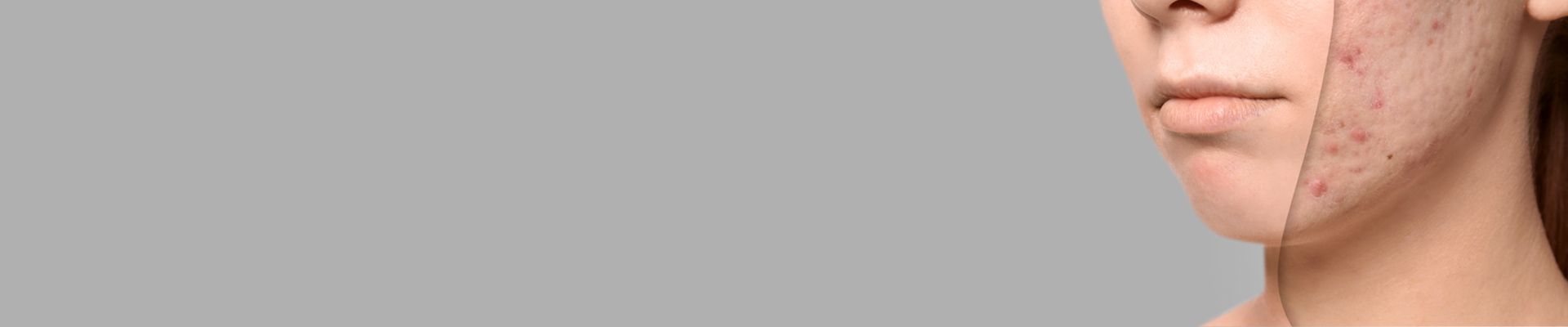 Los Angeles Acne Scar Treatment | Beverly Hills Acne Scars Removal