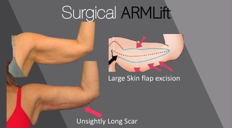 SmartARMLift Beverly Hills | Non-Surgical Arm Lift Los Angeles