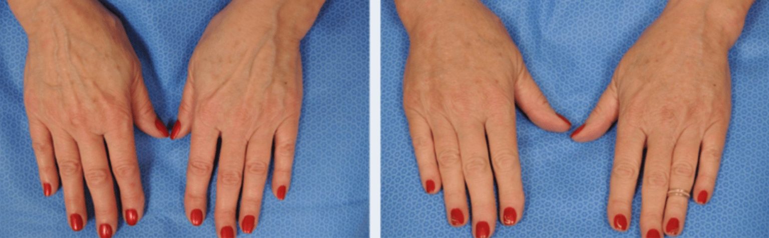 Los Angeles Hands Rejuvenation with Fat Grafting | Beverly Hills Aging ...
