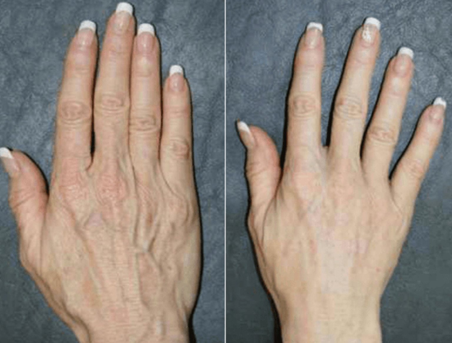 Los Angeles Hands Rejuvenation with Fat Grafting | Beverly Hills Aging ...