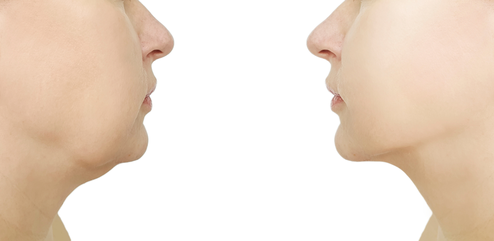 Get Rid of Your Double Chin With Lipo: A Noninvasive Solution | Beverly ...